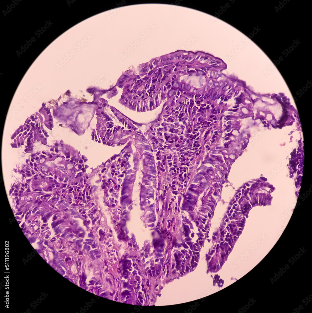 Terminal ileum(biopsy): Chronic nonspecific ileitis or inflammation of ...