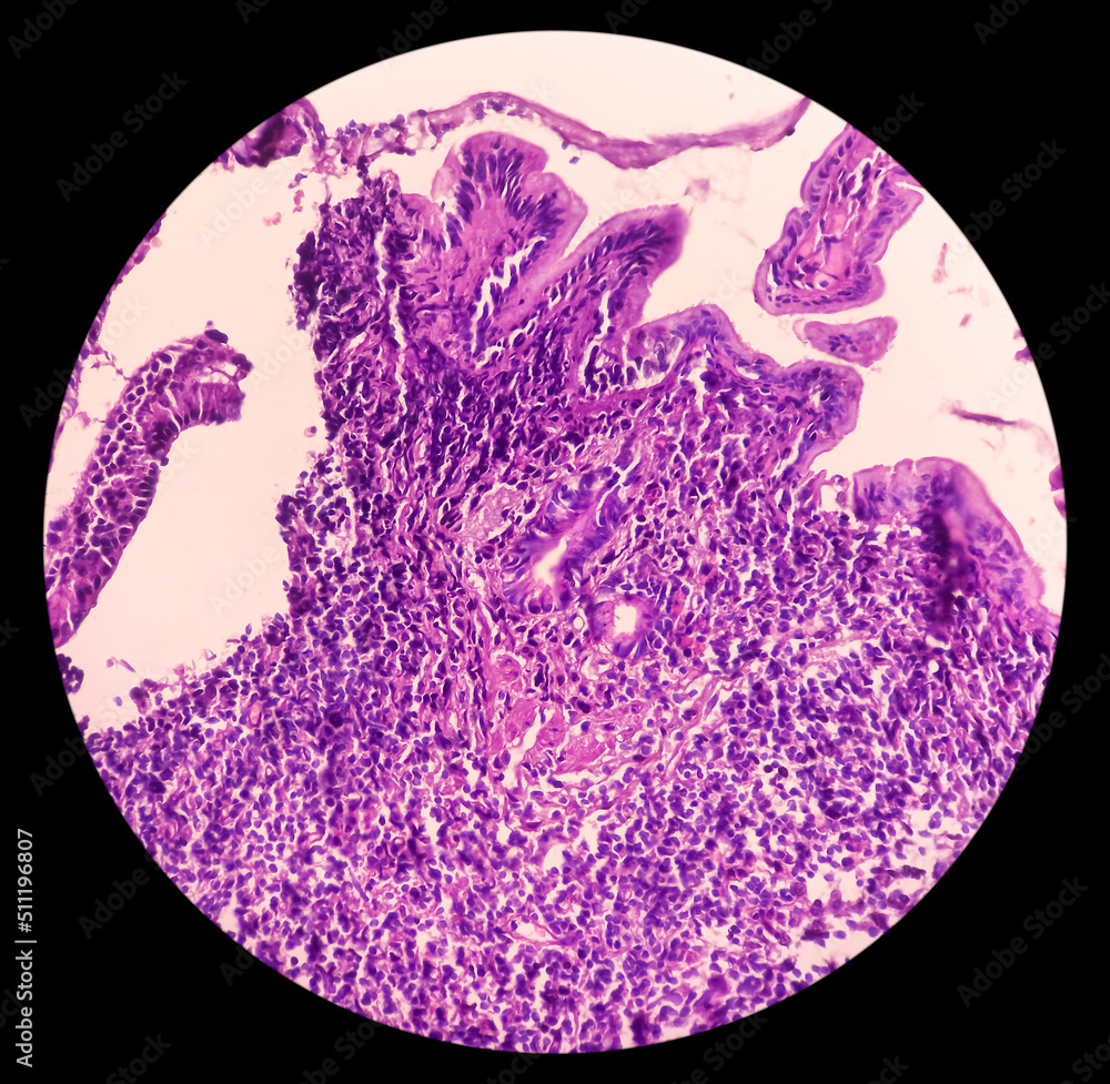 Terminal ileum(biopsy): Chronic nonspecific ileitis or inflammation of ...