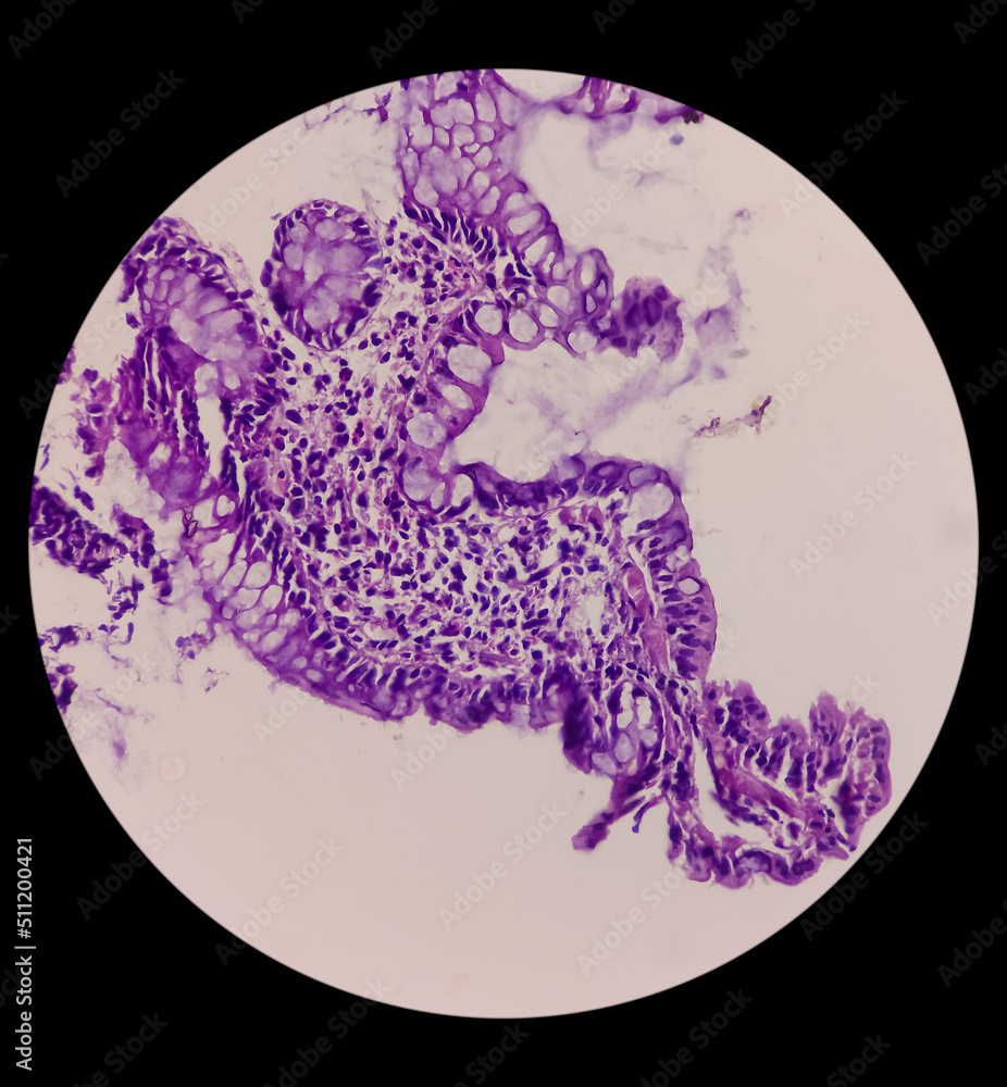 Terminal ileum(biopsy): Chronic nonspecific ileitis or inflammation of ...