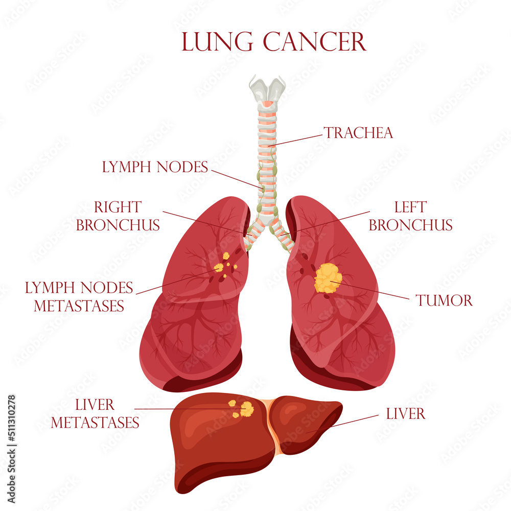 Diagram lung cancer disease. Concept disease human internal organs ...