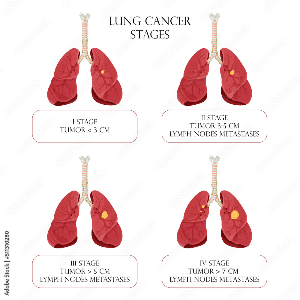 Lung cancer stages. Concept diseases human internal organs. Cartoon ...