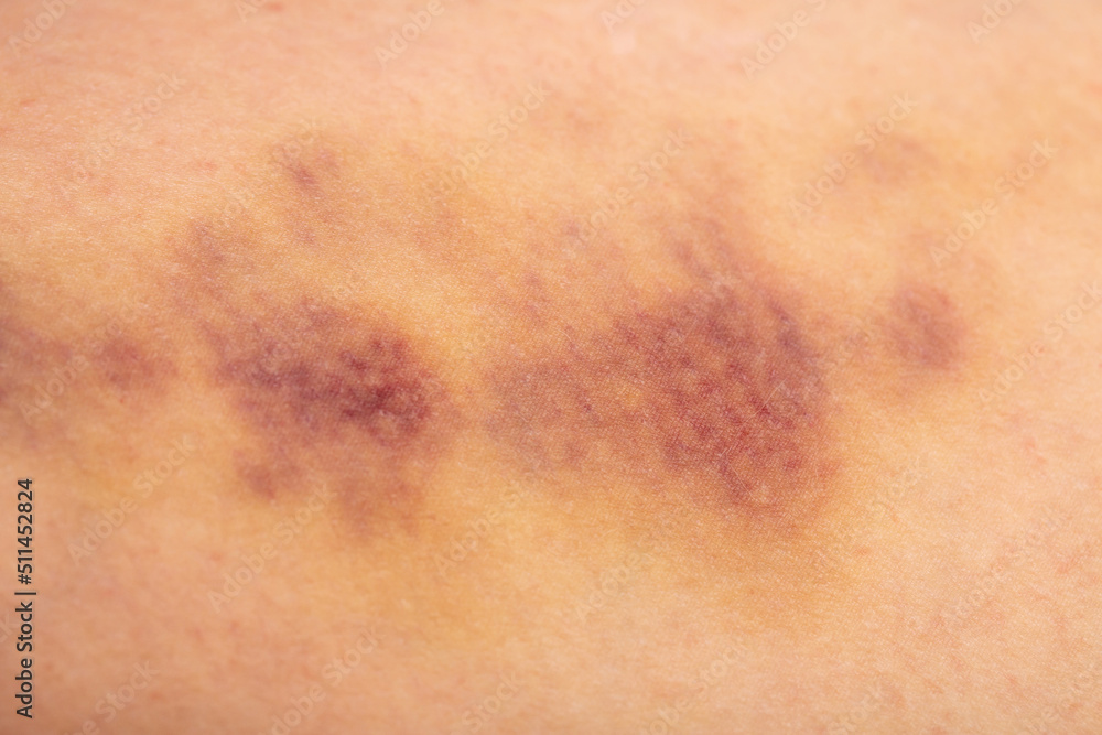 Bruises on the human body. Severe bruise from impact, bruising and ...