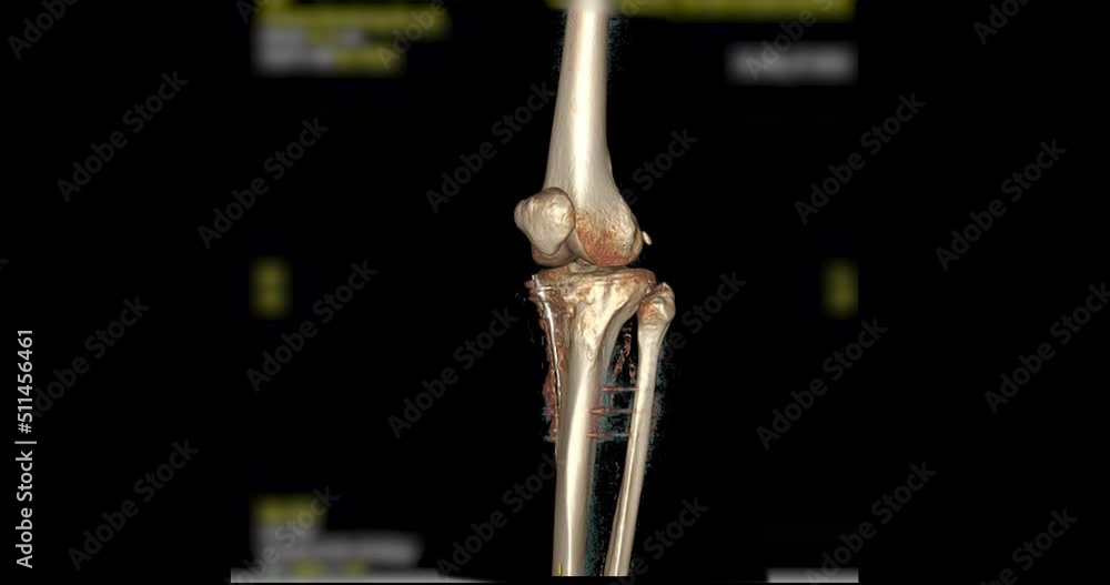 CT Scan of knee joint with fixation metal on the bone 3d rendering ...