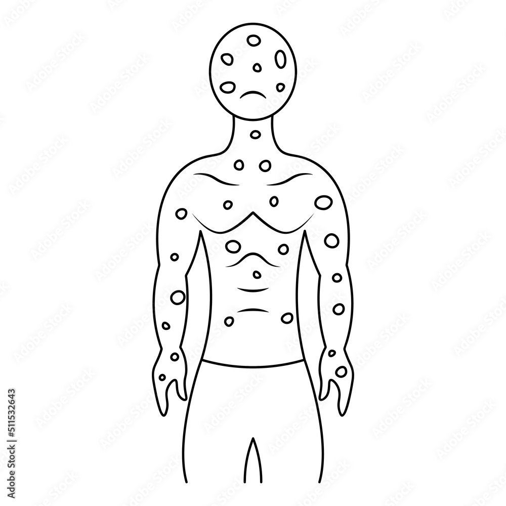 Smallpox on the human body. Sketch. Vector illustration. The face and ...