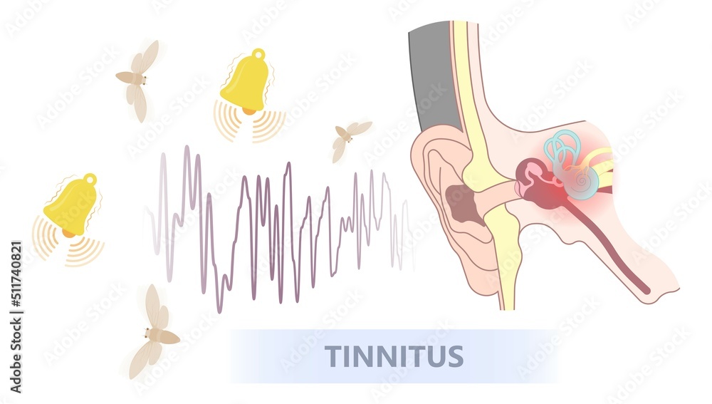 Tinnitus disorder a ringing sound in the ear hearing loss wave level ...