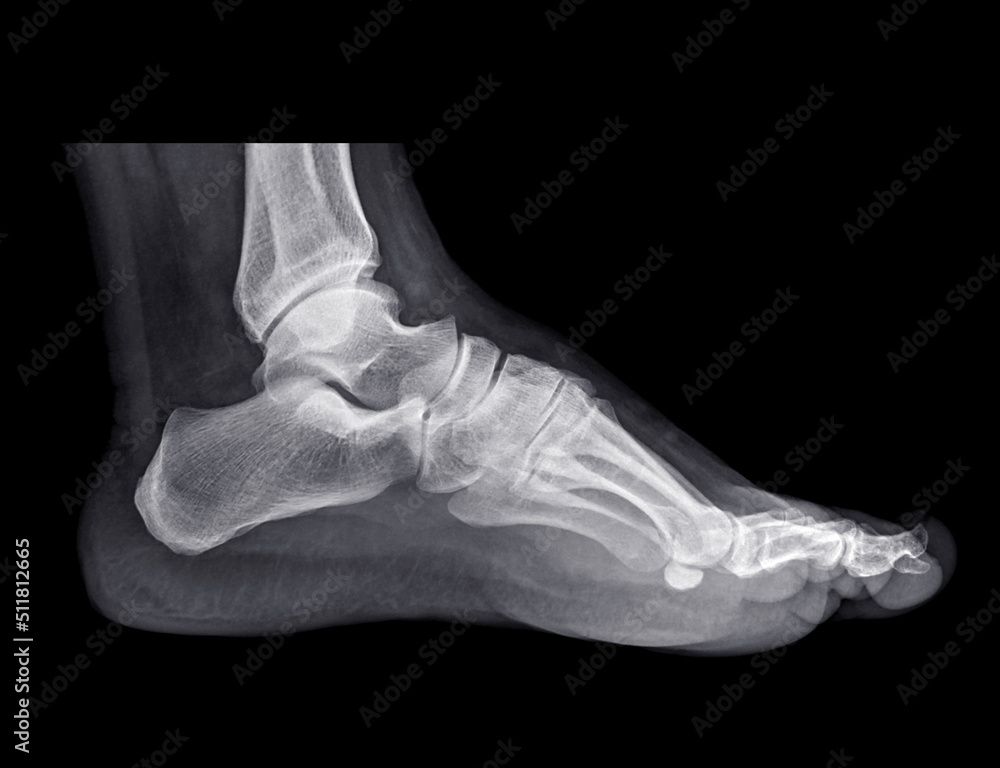 Foot x-ray image on isolated on black background. Stock Photo | Adobe Stock