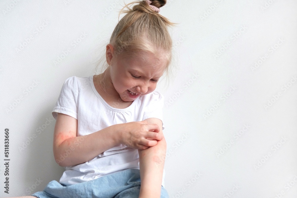 The child scratches atopic skin. The child applies a special cream to ...