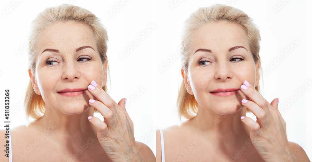 Middle age close up woman face before after cosmetic procedures. Skin ...