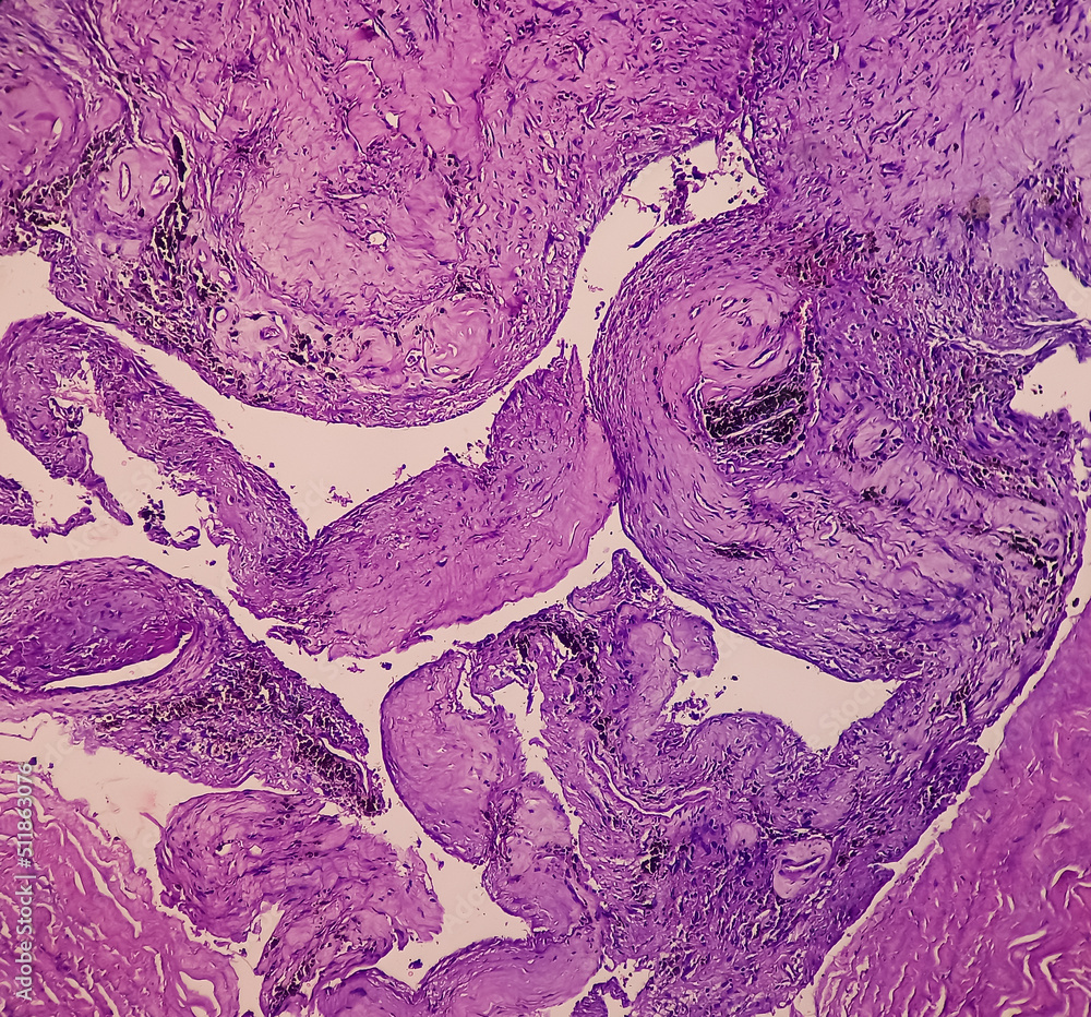 Photomicrograph of Schwannoma, a benign soft tissue tumor, enlarged ...