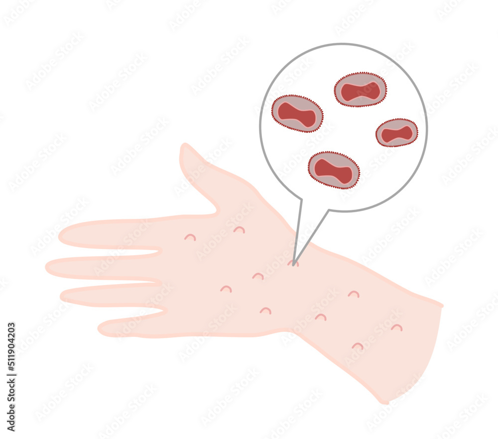 The rash on human hand are pathology symptom of smallpox or monkeypox ...