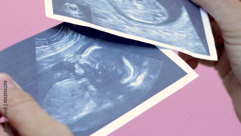 pregnancy and baby waiting. ultrasound picture with fetus in uterus in ...