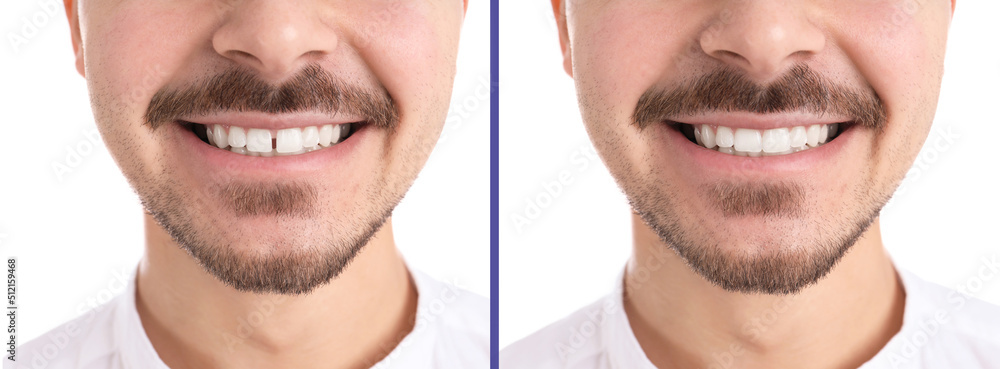 Collage with photos of man with diastema between upper front teeth ...