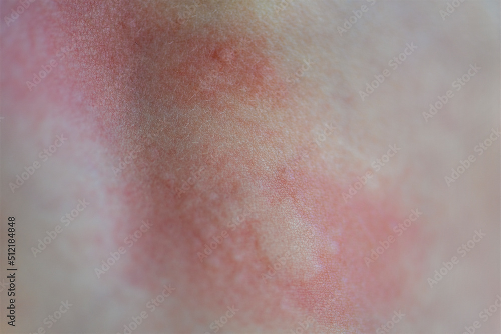 Urticaria on the skin. Red spots of an allergic reaction on the skin of ...