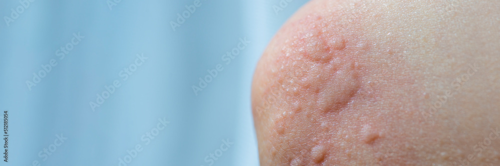 Urticaria on the skin. Red spots of an allergic reaction on the skin of ...