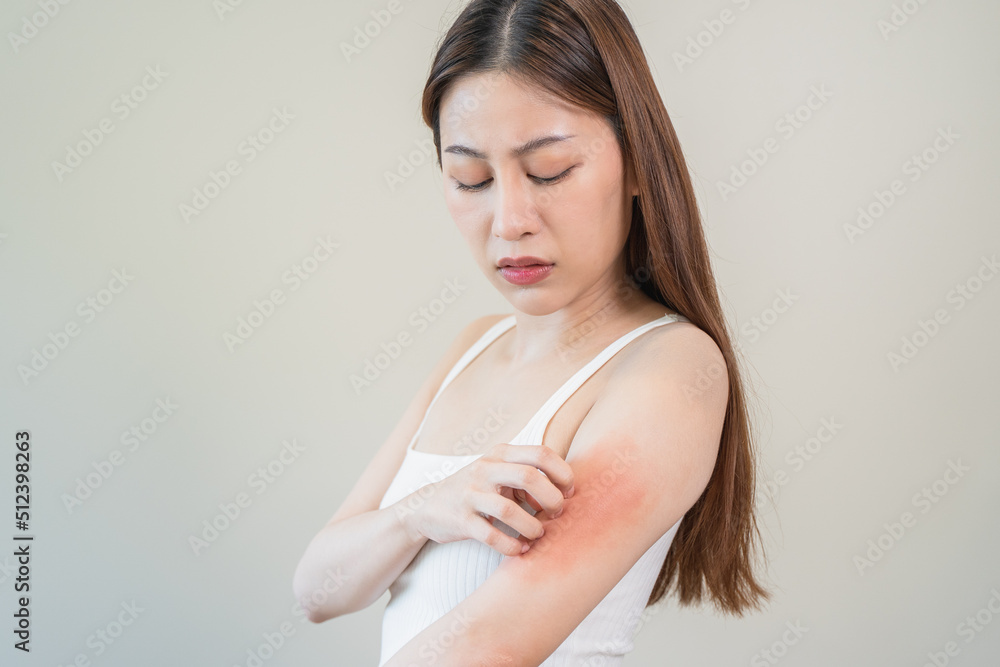 Póster Sensitive skin allergic concept, Woman itching on her arm have a ...