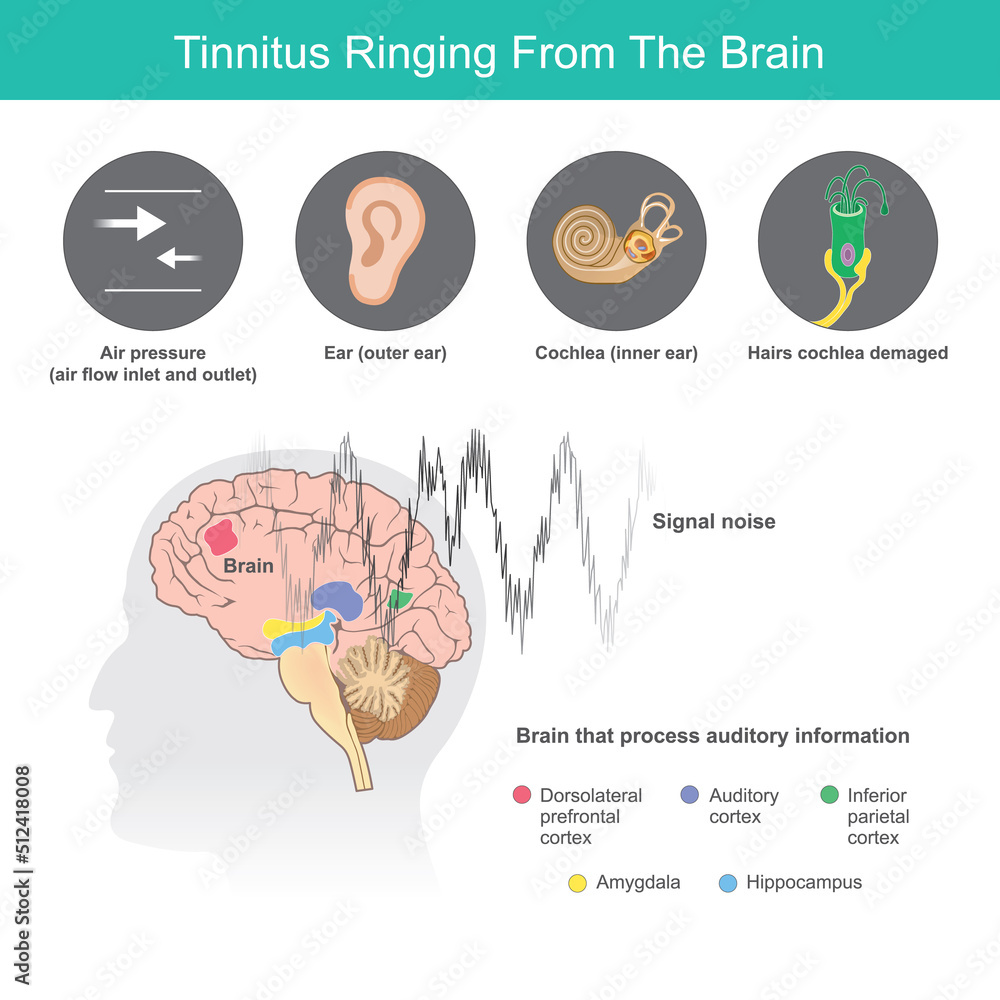 Tinnitus Ringing From The Brain, Is the term for a buzzing noise in ...