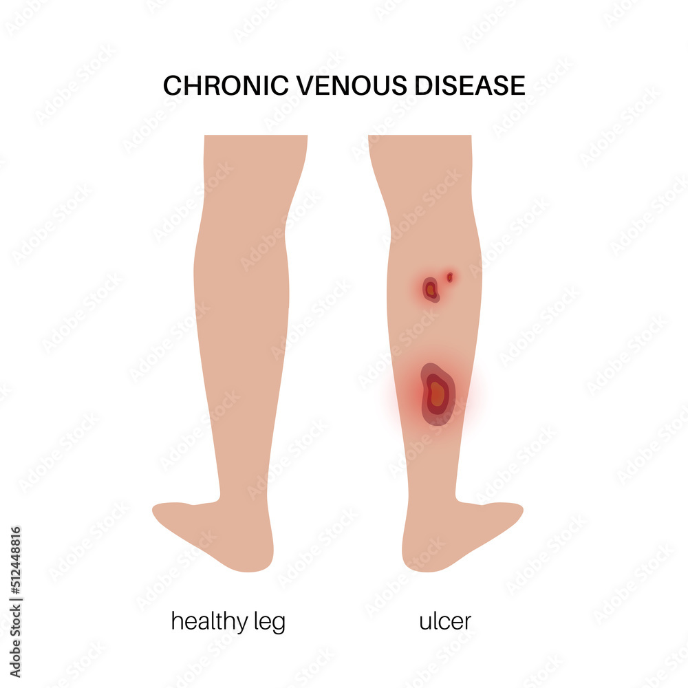 Trophic ulcer anatomy Stock Vector | Adobe Stock