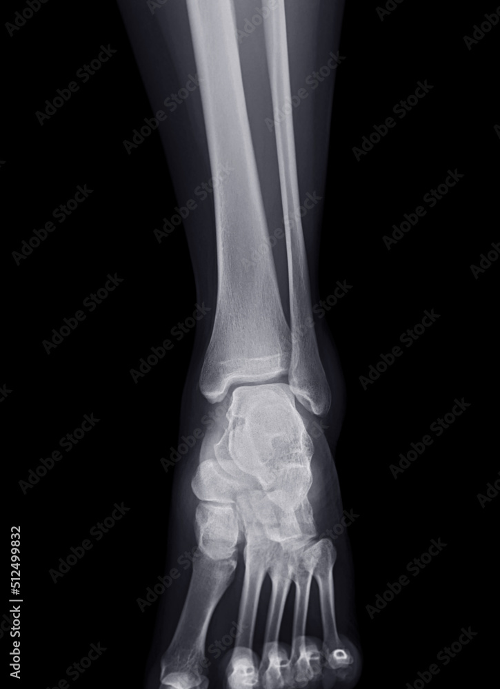 X-ray image of ankle joint for diagnosis fracture tibia and fibula bone ...