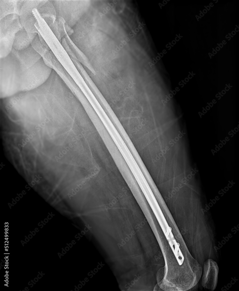 X-ray femur bone Fracture After Total Hip and femur Replacement. Stock ...