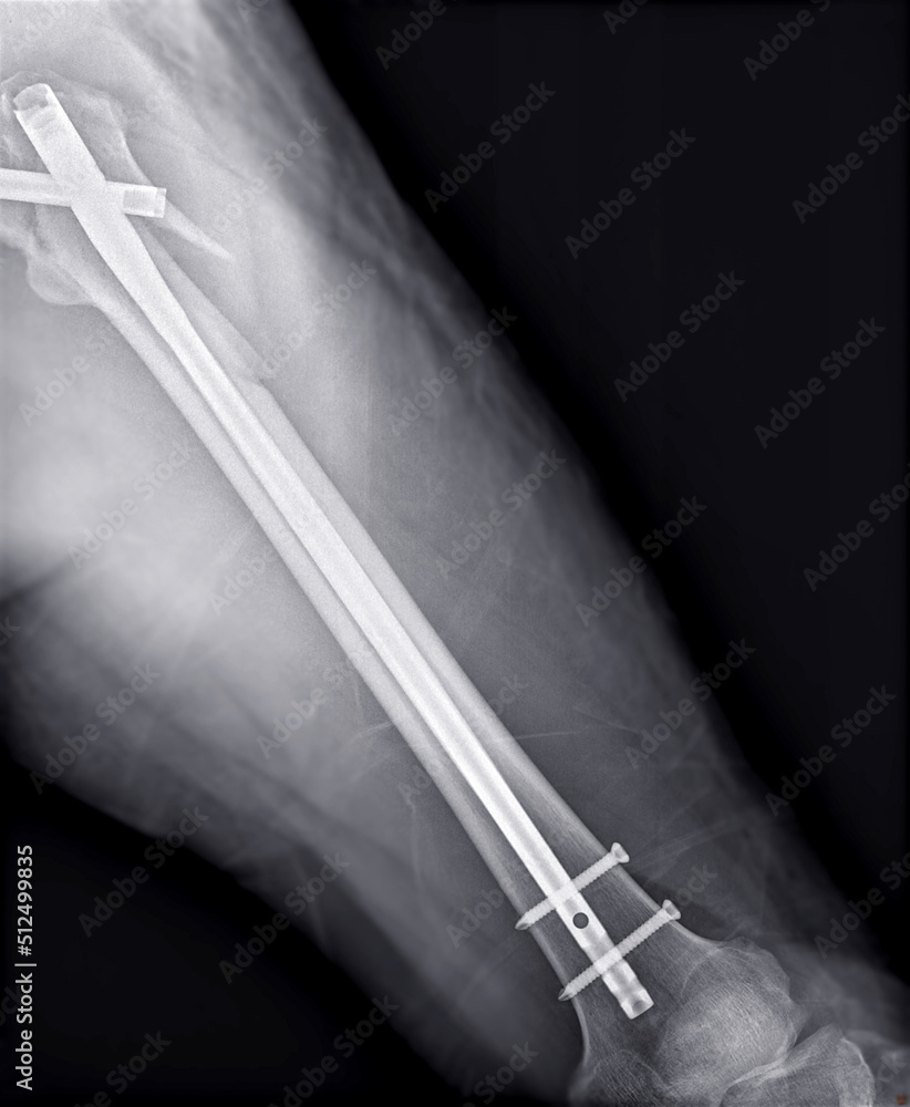X-ray femur bone Fracture After Total Hip and femur Replacement. Stock ...