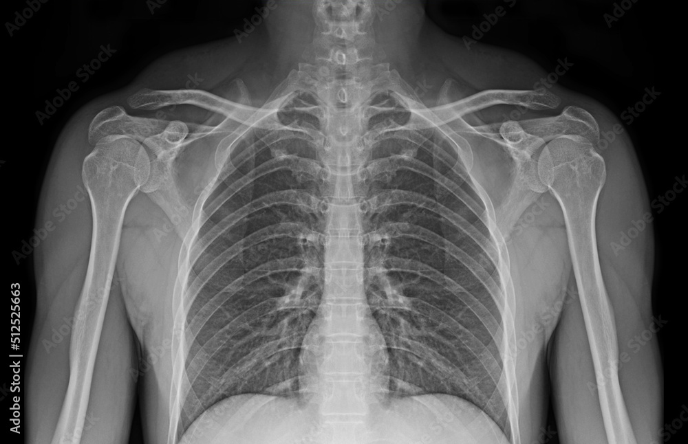 Gallery Xray Body X Ray Body Of Child And Blank Area At Left Side