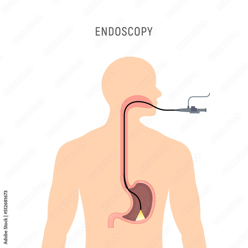 Endoscopy stomach anatomy equipment vector illustration. Esophagus ...