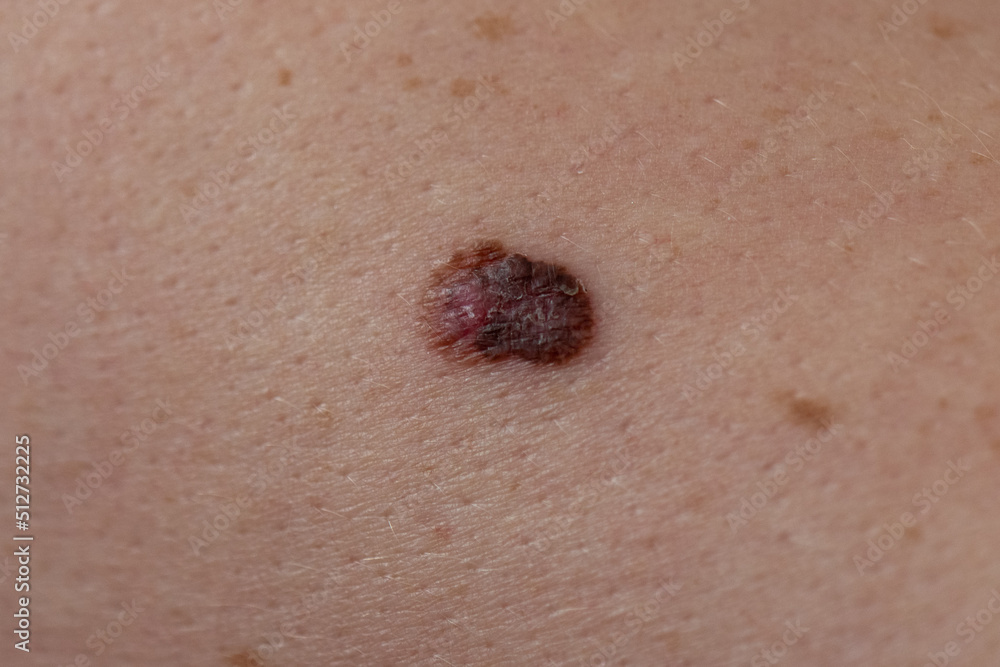 extreme close up of a large mole that was diagnosed as malignant ...