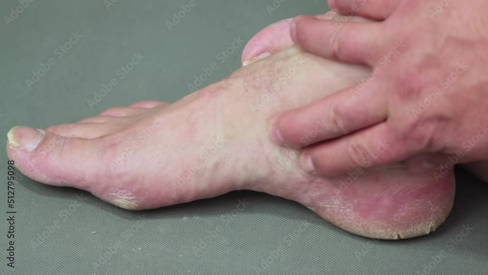 A man's hand strokes the foot and heel. Keratinization and thickening ...
