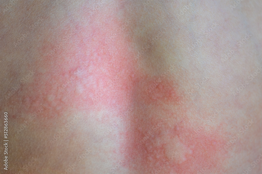 Urticaria on the skin. Red spots of an allergic reaction on the skin of ...