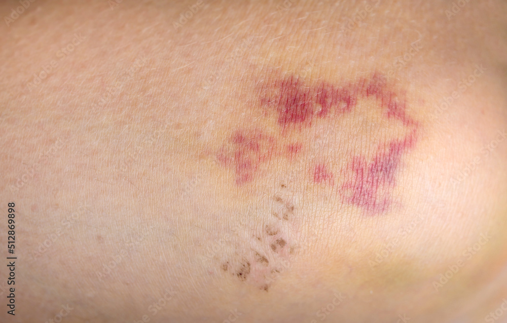 Foto de Bruises on the human body. Severe bruise from impact, bruising ...