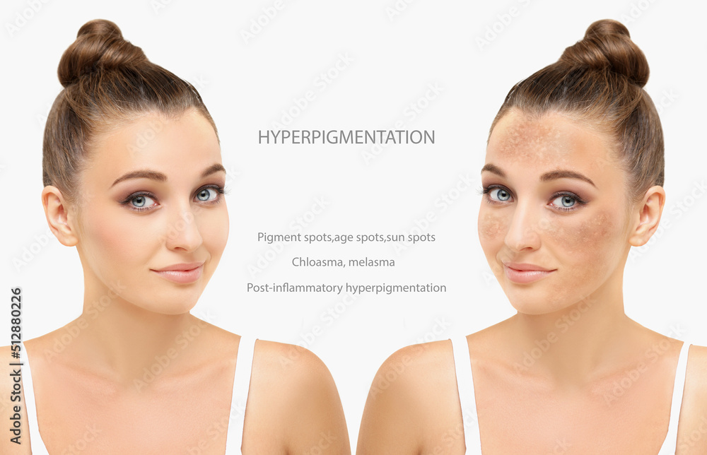 Hyperpigmentation: chloasma, melasma , age spots,Post-inflammatory ...