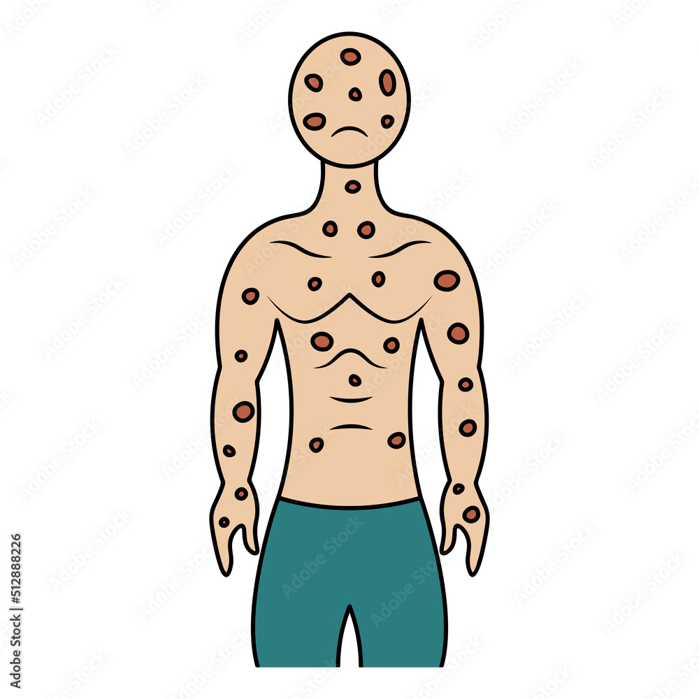 Smallpox on the human body. Color vector illustration. The face and ...