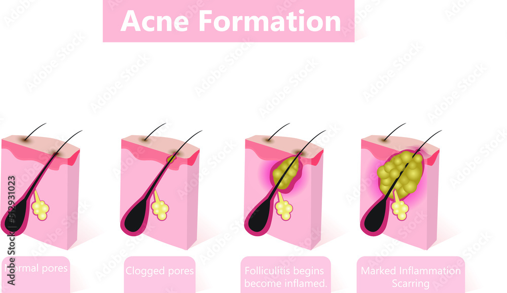 Formation of skin acne or pimple. The sebum in the clogged pore ...