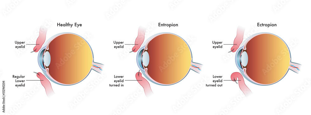 Medical illustration shows the comparison between a normal eye, one ...