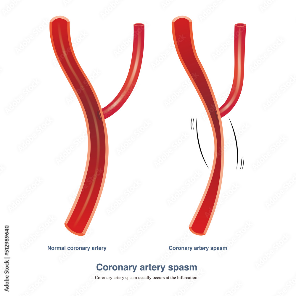 Coronary artery spasm is the pathogenesis of variant angina pectoris ...