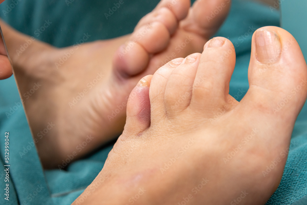 Broken and bruised little toe from blood spill Stock Photo | Adobe Stock
