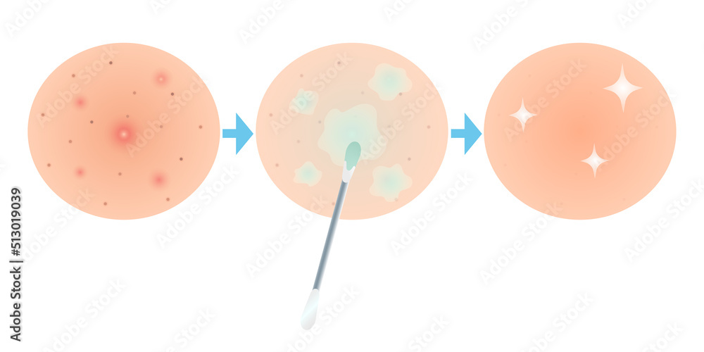 Acne treatment skin problems. Before after. Clean skin icons. Zoom ...
