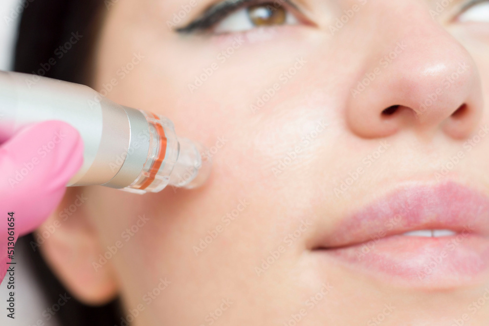 Needle mesotherapy. Cosmetologist performs needle mesotherapy on a ...