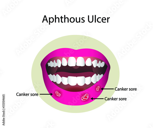 Naklejka illustration of biology and medical, Aphthous ulcer, Mouth ...