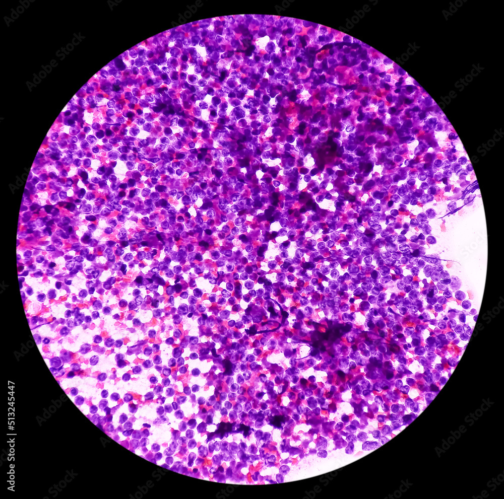 Microscopic image of Lymphoproliferative disorder at cervical lymph ...