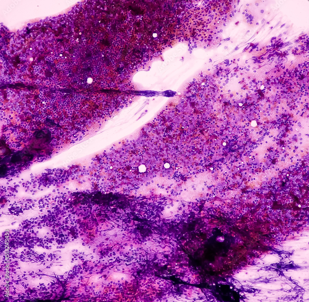 Microscopic image of Lymphoproliferative disorder at cervical lymph ...