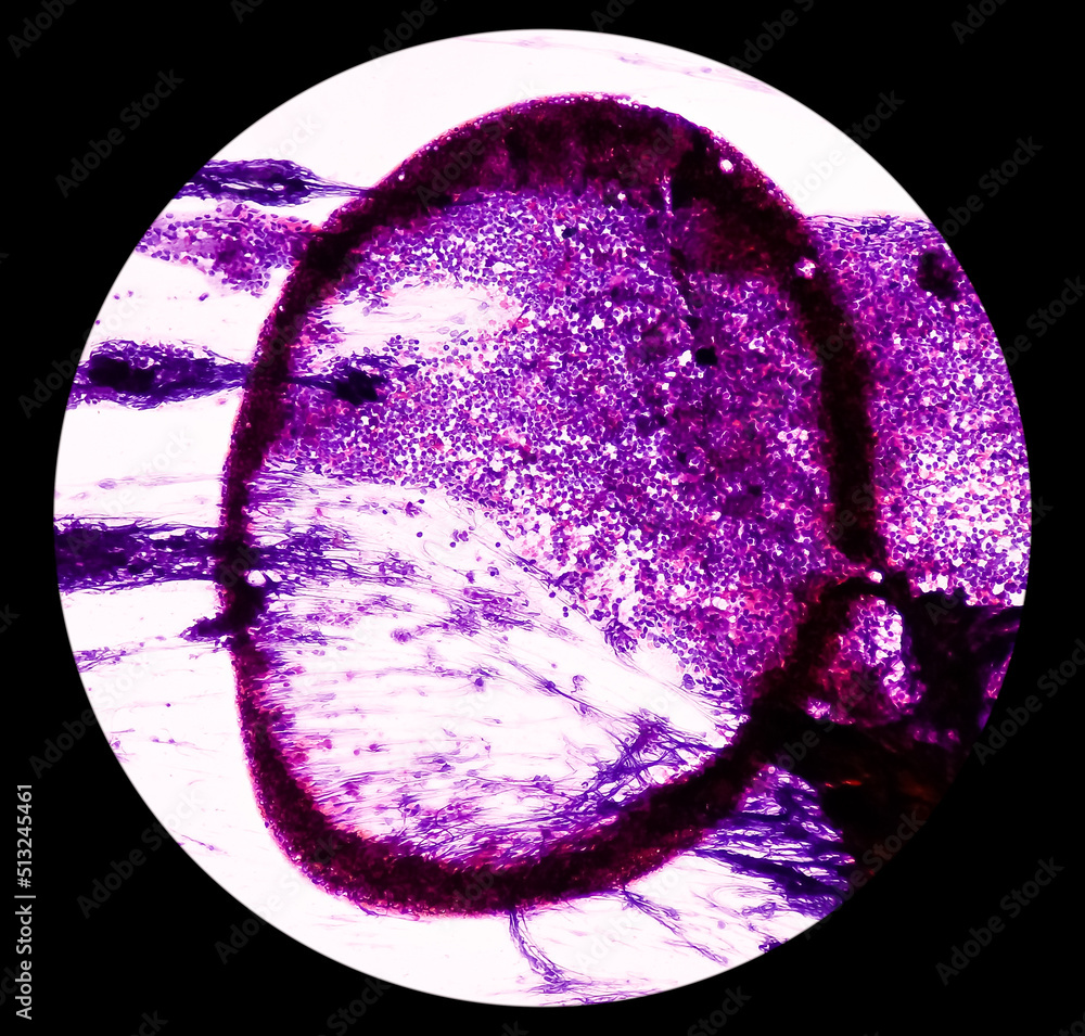 Microscopic image of Lymphoproliferative disorder at cervical lymph ...