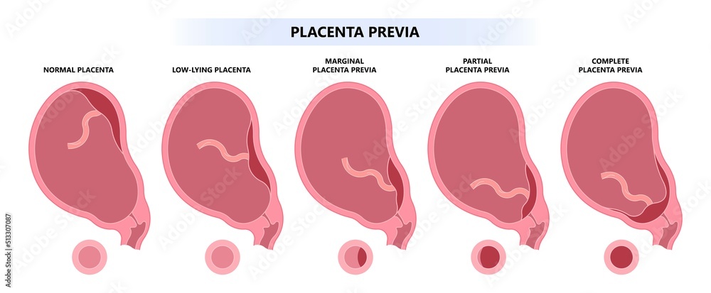 uterus contraction baby of vasa previa fetal infant born c section ...
