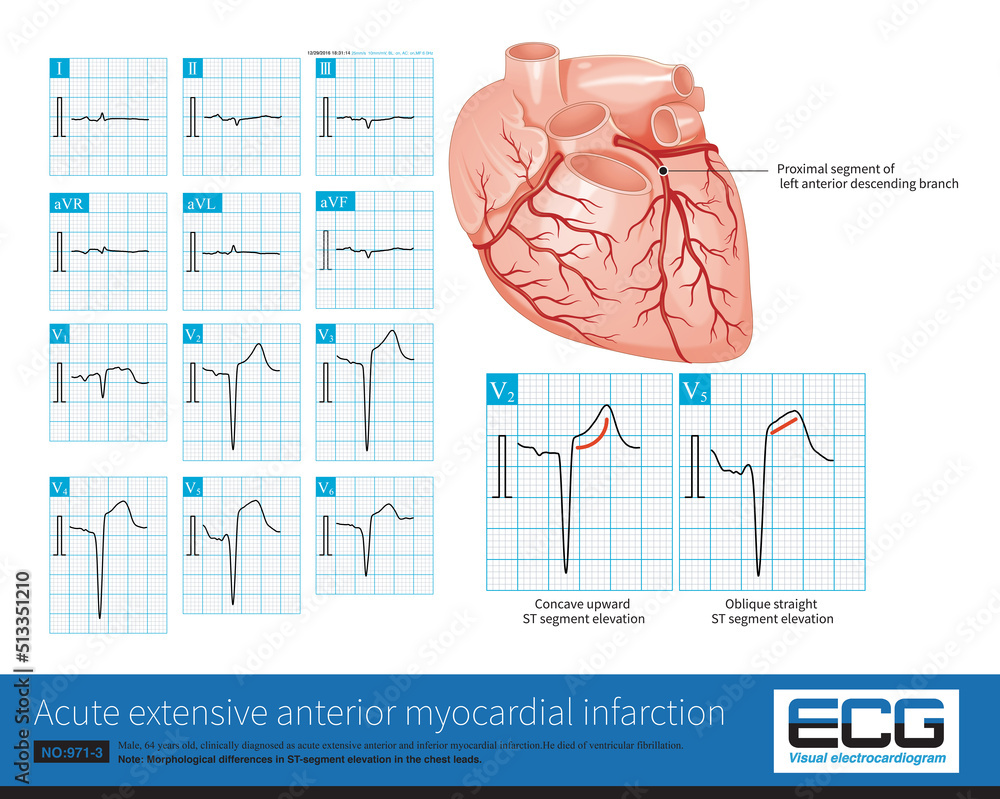 Male, 64 years old, admitted with chest pain for 4 hours. The clinical ...