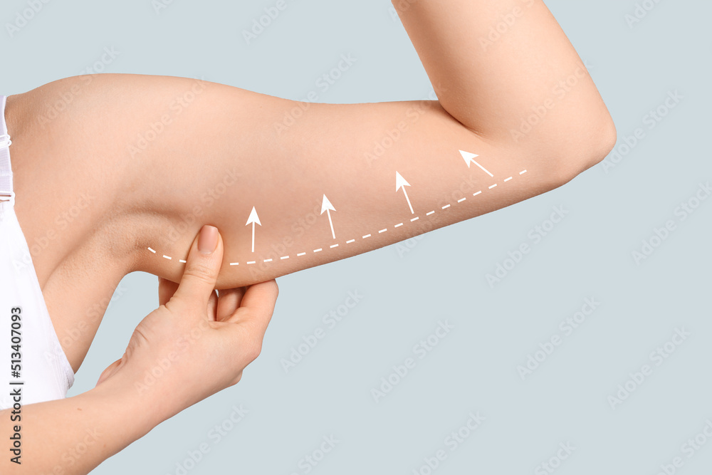 Arm of young woman after slimming on light background. Plastic surgery ...