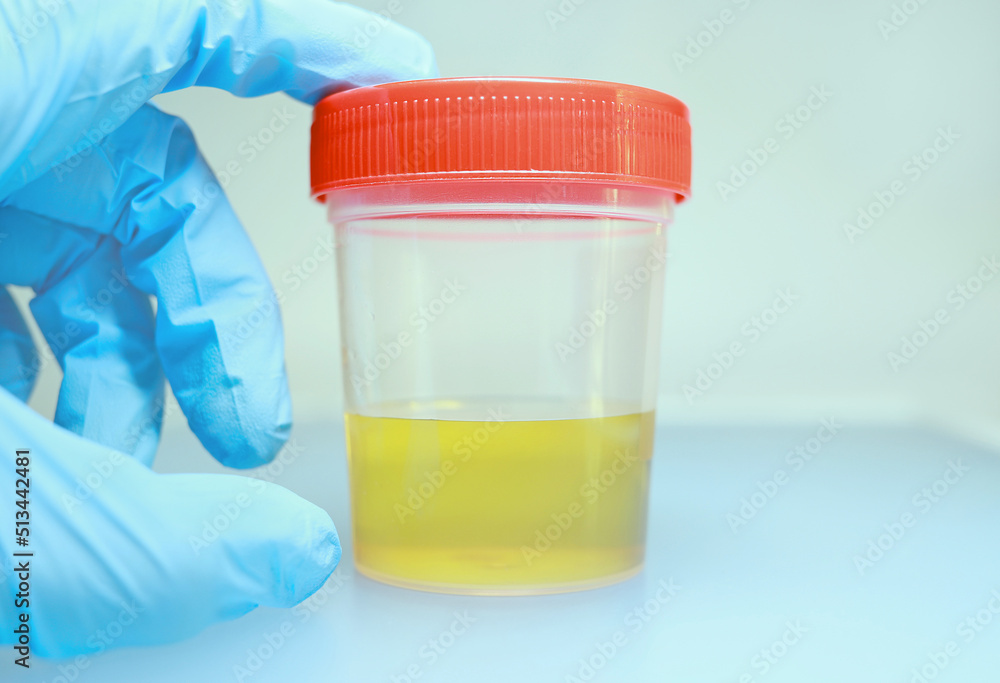 40 ml urine sample in a biomaterial container on medical background ...