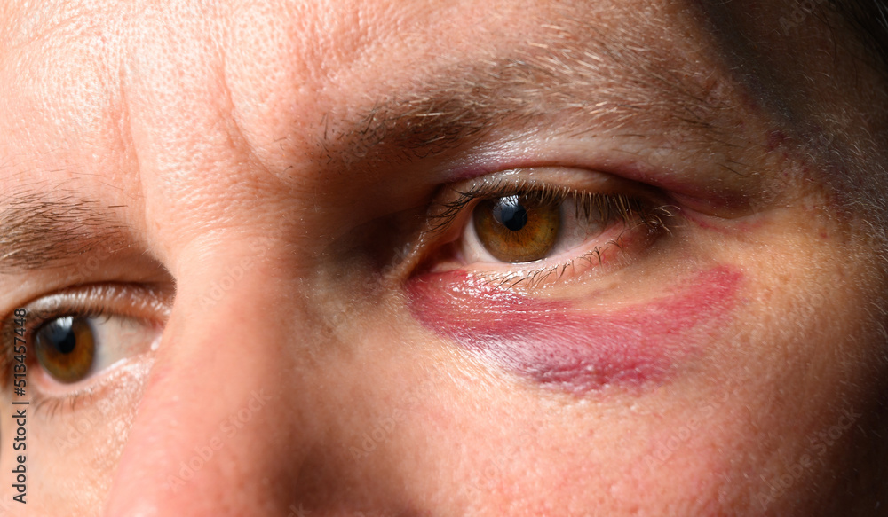 Bruise and swelling from a blow on the face of a man close-up foto de ...