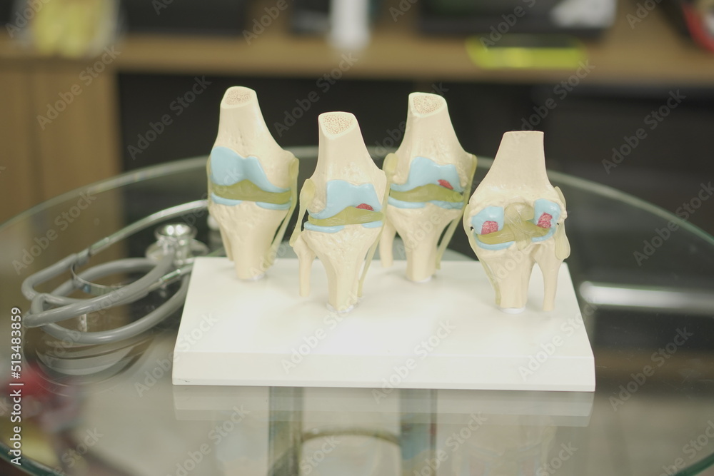 A model of the knee joint structure, Osteoarthritis , close up, medical ...