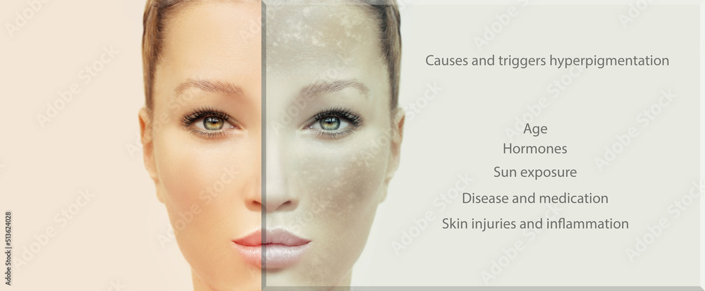 Hyperpigmentation: chloasma, melasma , age spots,Post-inflammatory ...