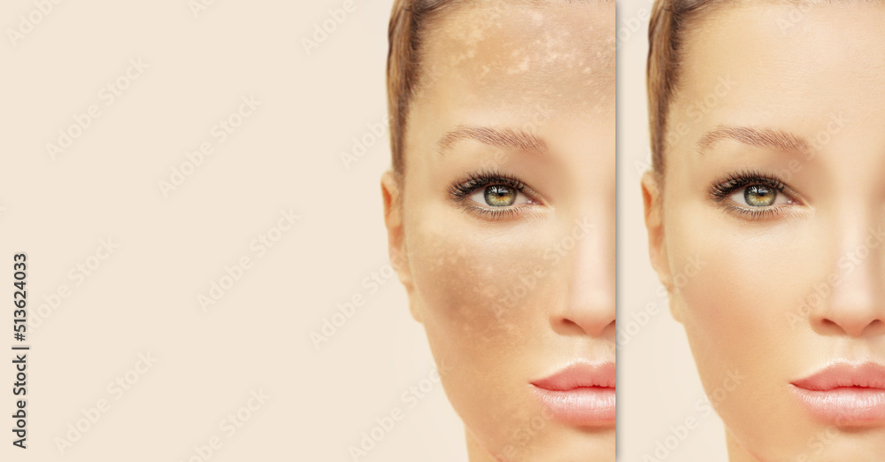 Hyperpigmentation: chloasma, melasma , age spots,Post-inflammatory ...
